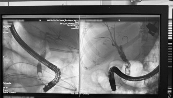 Incor de Prudente realiza 1ª colangioscopia da região para remoção de ...